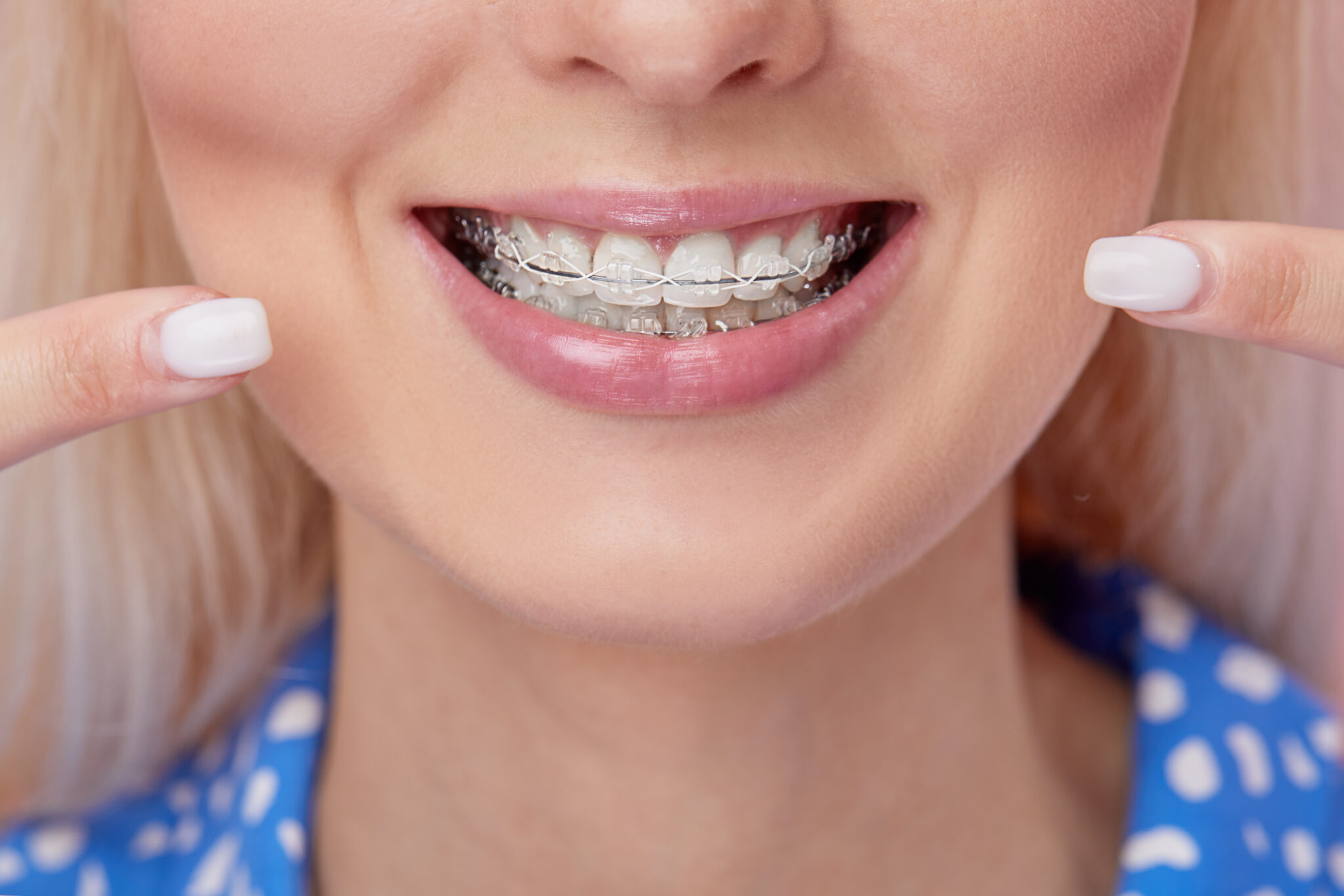 How Do You Keep Your Teeth White While Wearing Braces? | The Smile Patio